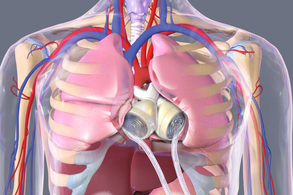 Journal of Cardiothoracic Surgery Publishes 1st Case Report of Using Single-Site Cannulation ...